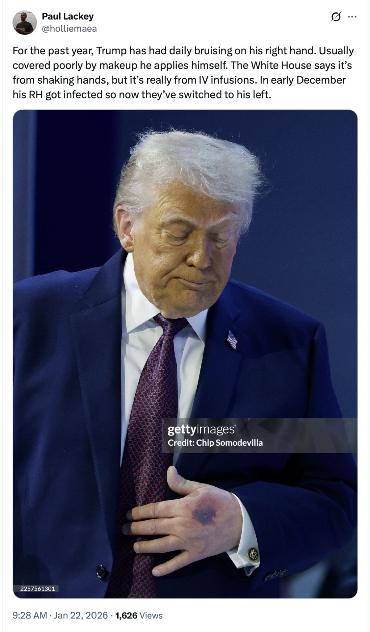 President Trump Explains The New Bruising On His Hand * 100PercentFedUp ...